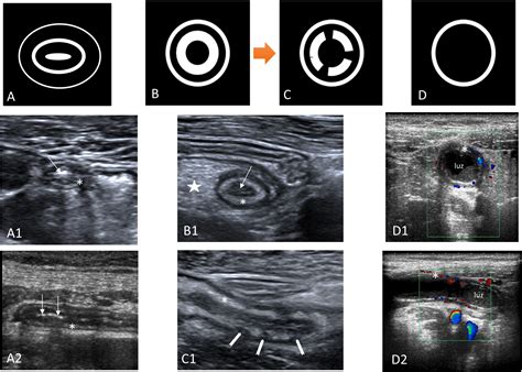 Update On Acute Appendicitis Typical And Untypical Findings