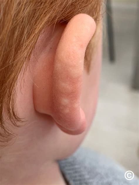 Polymorphic Light Eruption And Juvenile Spring Eruption