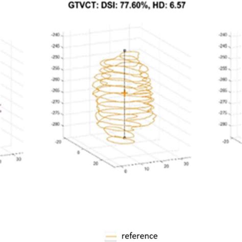 Example Of The Mathematical Comparison Between Ct And Mri Contour