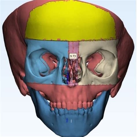 Outlines Of Osteotomies Of Box Osteotomy And Amount Of Bone Removal