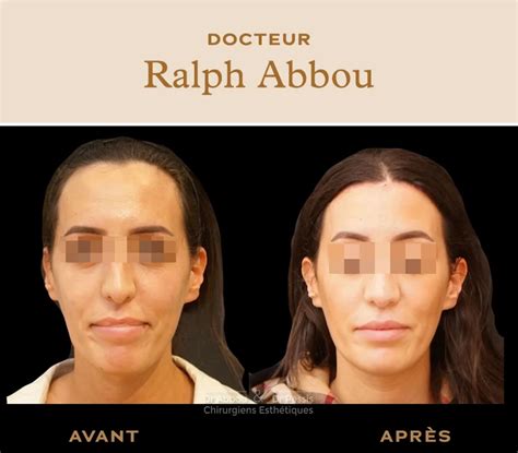 Reduction Du Front Abaissement Ligne Frontale Paris Dr Abbou