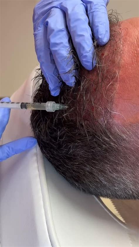 Prp After Hair Transplant 😌 [video] In 2025 Hair Transplant Hair