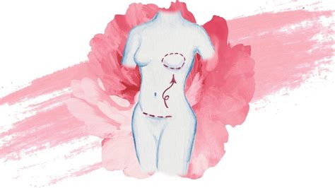 Lumpectomy With Perforator Flap Reconstruction An Innovative Approach Techo Earth