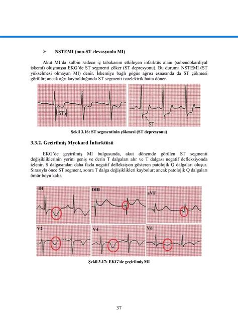 Ekg Elektrokardiografi Pdf