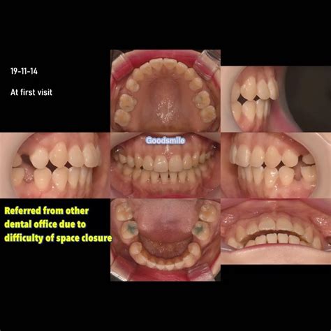 굿스마일치과 Retreatment Of Dental Class Ii With Open Bite And Re 굿스마일치과
