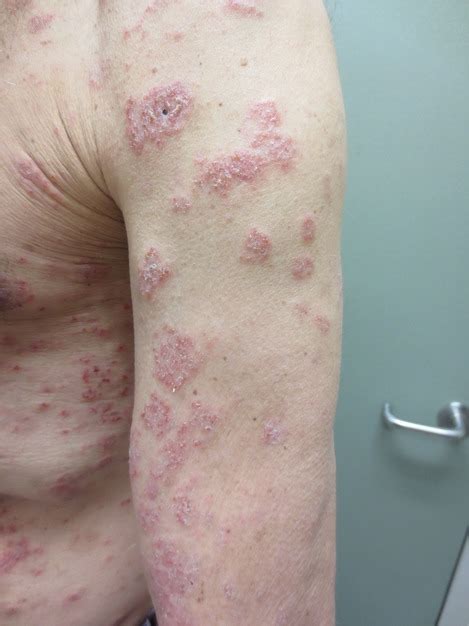 Pemphigus Herpetiformis