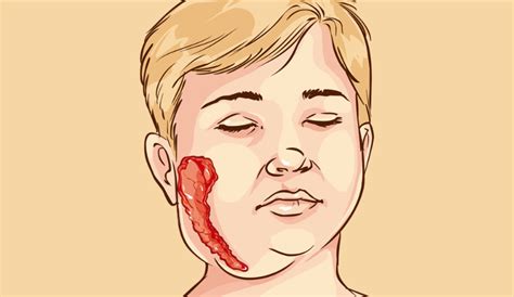 Parotiditis Fundación Io