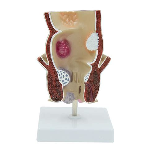 Anatomy Human Rectal Hemorrhoid Lesion Model Pathology Teaching Model