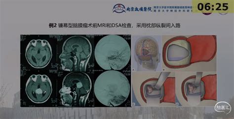 杭春华教授：小脑幕脑膜瘤的显微外科手术 脑医汇