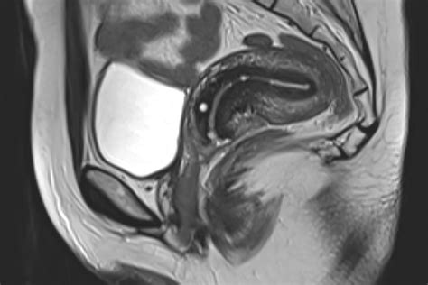 Retroverted Uterus Causes And Consequences