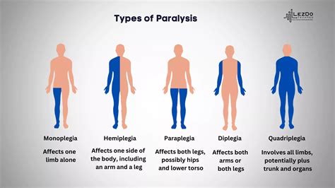 Paraplegia Causes Paralysis Sai Sanjivani