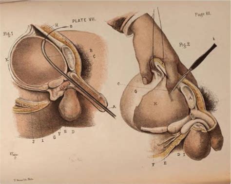 Suprapubic Prostatectomy Prostate Cancer Surgery Prostatectomy