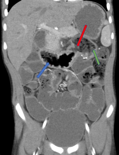 Intestinal Malrotation And Midgut Volvulus Image