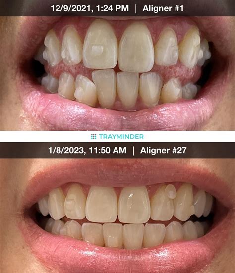 13 Month Update Ortho Went To A Bootstrap For My Stubborn Lateral
