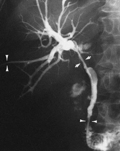 Interventional Gastrointestinal Radiology Radiology Key