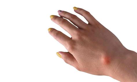 Cystic Hygroma Meaning Symptoms Causes Diagnosis And Treatment