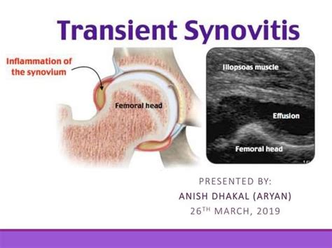 Transient Synovitis Of The Hip