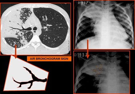 Air Bronchogram Sign Chest Ct And Chest Radiograph Demonstrate Air