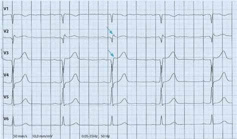 Das Pathognomonische Ruhe Ekg Bei Brugada Syndrom Zeigt Sattelförmige