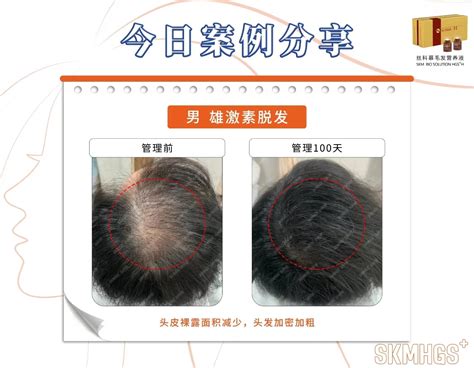 头发两边头顶稀疏怎么调理？ 哔哩哔哩
