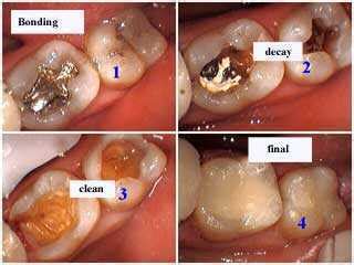 Dental Restorations Using Composite Resin Fillings
