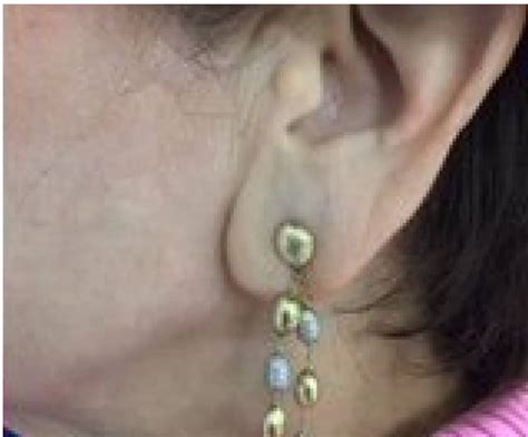 Earlobe Repair After Case 73681 Sobel Skin