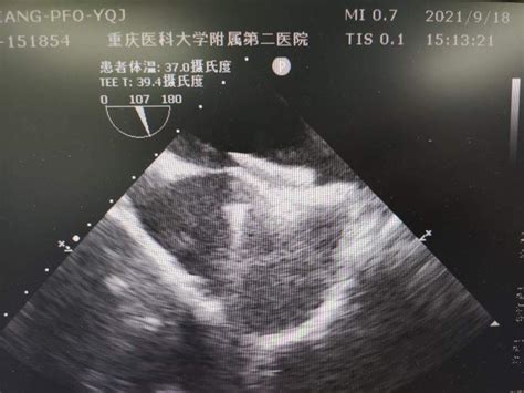近期完成的两台超声引导下卵圆孔未闭封堵 微医（挂号网）