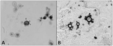 Paracoccidioides Brasiliensis Life Cycle