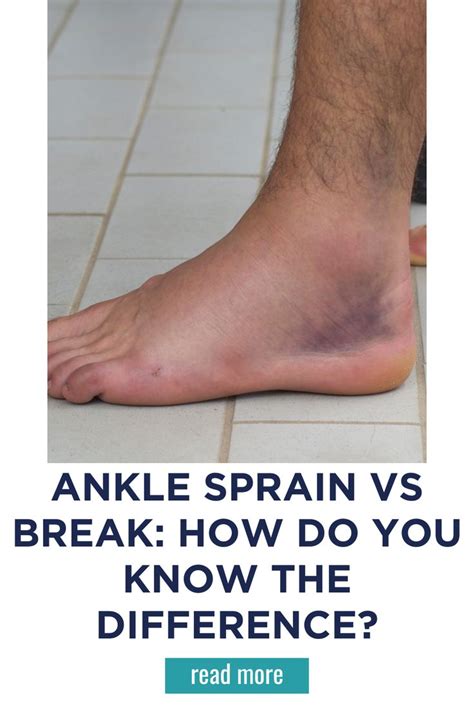 Ankle Sprain Vs Break How Do You Know The Difference In 2024 Sprained Ankle Broken Ankle