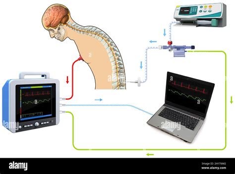 Lumbar Puncture Spinal Tap Canal Diagnostic Collect Sample Patient
