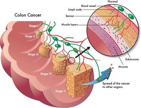 Crohns Disease What You Need To Know Parkland Natural Health In London