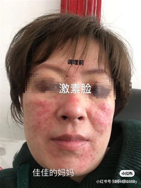 激素脸敏感肌妈妈的心酸历程 知乎