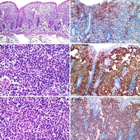 Histopathological Features Of Alpha Heavy Chain Disease With