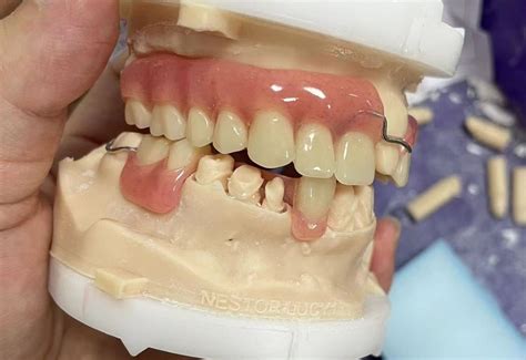 Partial Acrylic Denture Mtz Dental Lab