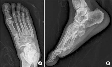 Cuboid Bone Fracture Fasrflash