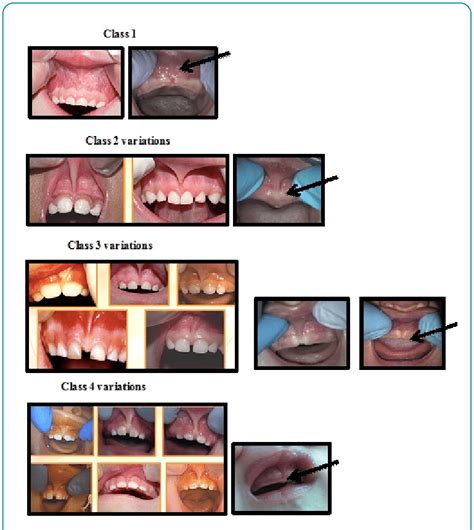 Lawrence L Kotlow Upper Lip Tie Classifications Download Scientific