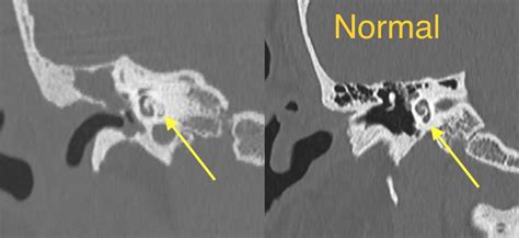 Imaging Of Labyrinthitis Ossificans Etiology Sequelae Of Chronic