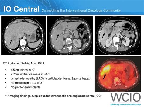 Multi Modality Approach To Managing Intrahepatic Cholangiocarcinoma