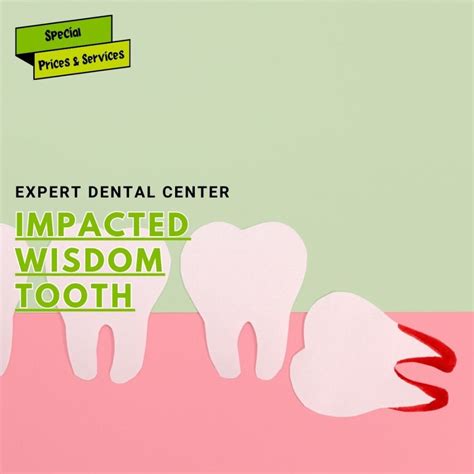 Impacted Wisdom Tooth