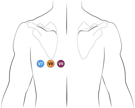 Ecg Lead Positioning • Litfl Medical Blog • Ecg Library Basics Medicine