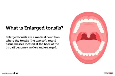 Swollen Tonsils Tonsillitis Symptoms Causes And More 40 OFF