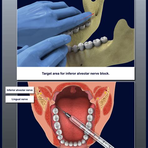 Inferior Alveolar Block Injection