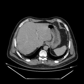 Control Computed Tomography On Follow Up After 2 Months Showed Almost