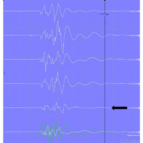Mep Traces Recorded From The Left Tibialis Anterior Muscle During