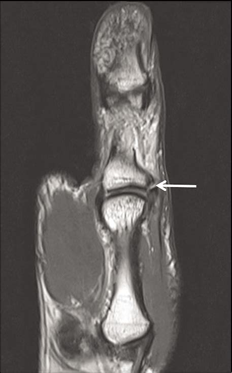 Ulnar Collateral Ligament Mri Thumb