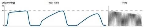 Em Didactic Capnography Beyond Rosc
