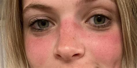 Sle Malar Rash Pictures I See A Lot Of Questions Asking About What Is