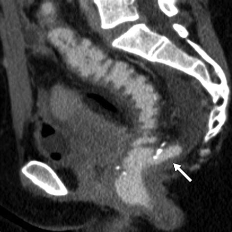 Ct Antegrade Colonography To Assess Proctectomy And Temporary Diverting