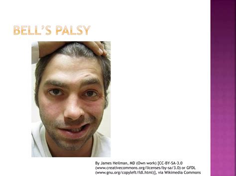 Facial Nerve Palsy Ppt