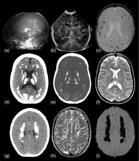 Symptoms Of Brain Calcification